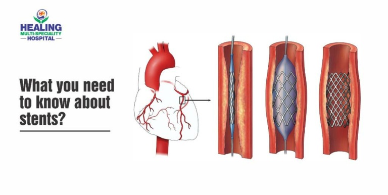 What you need to know about stents? - Healing Hospital