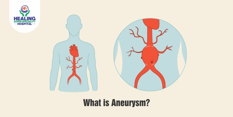 What is Aneurysm? - Healing Hospital