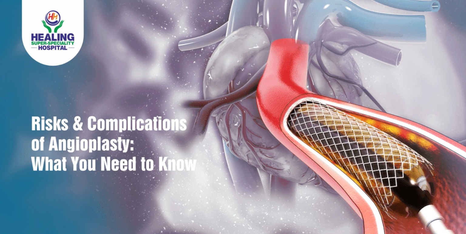 Risks and Complications of Angioplasty: What You Need to Know Risks and ...